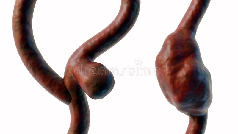 3d Rendering of an Isolated Saccular Aneurysm and Saccular Fusiform ...