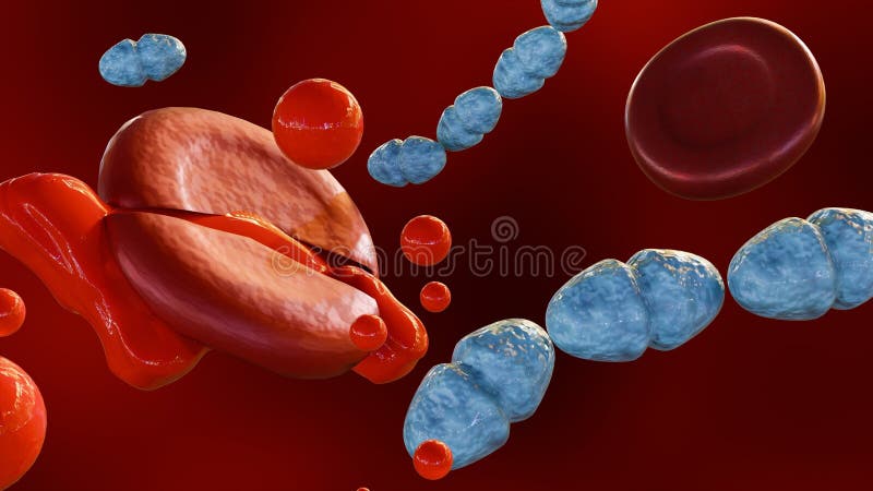 3d Rendering of Septicemia, or Sepsis by Streptococcus Pyogenes Stock ...