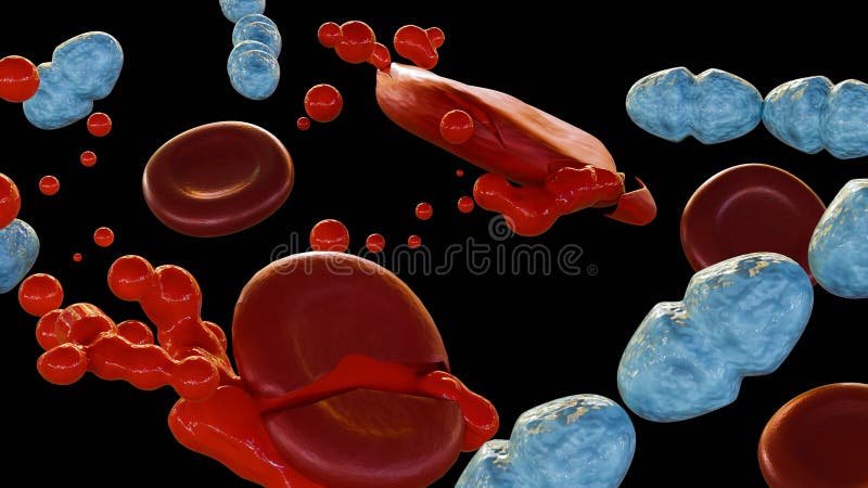 3d Rendering of Septicemia, or Sepsis by Streptococcus Pyogenes Stock ...