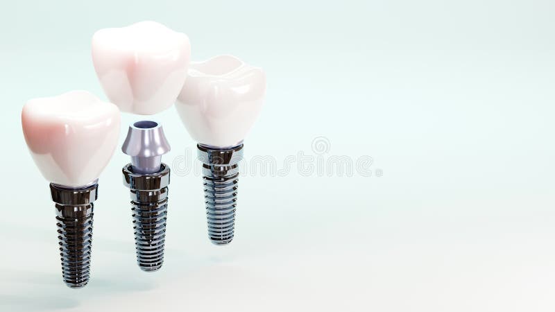 3D Rendering of Tooth Implants with Ceramic Crowns on Color Background ...