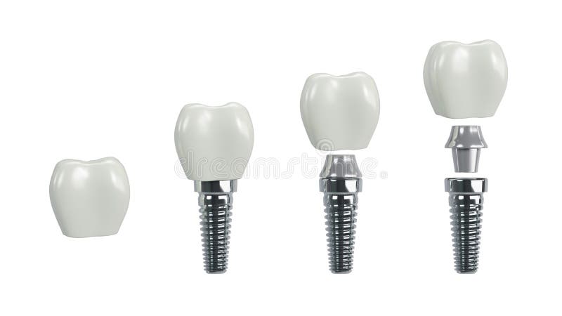 3D Rendering of Tooth Implants with Ceramic Crowns on a White ...
