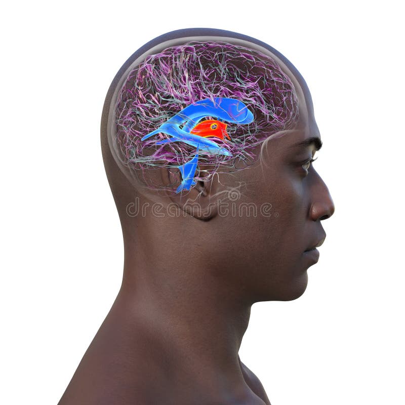 The Third Brain Ventricle, 3D Illustration Stock Illustration - Illustration of abnormalities ...