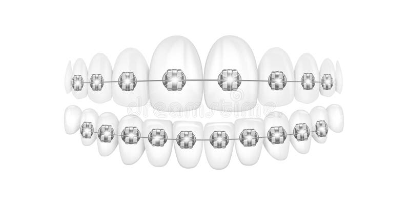 3d Vector Illustration, Realistic Teeth with Braces. Alignment of the ...