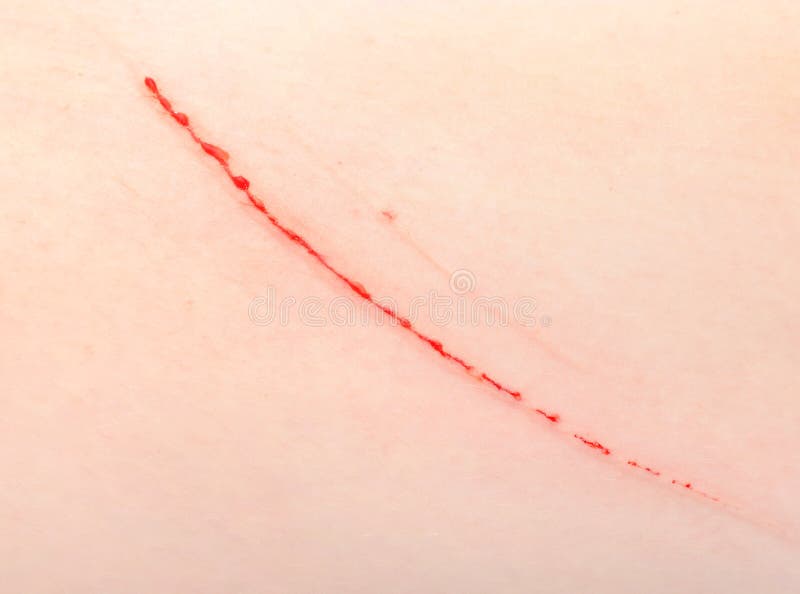 Damage To the Top Layer of the Skin Stock Image - Image of human ...