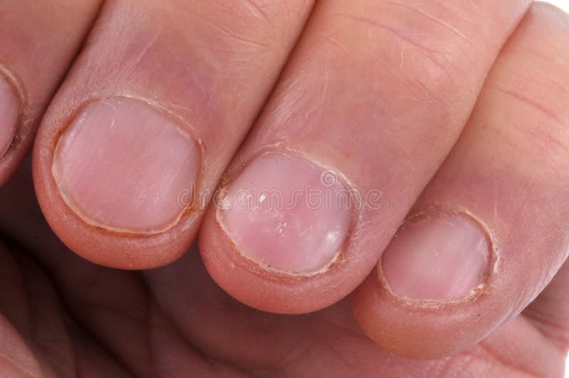 Damaged and Bitten Fingernails Close-up Stock Photo - Image of ...
