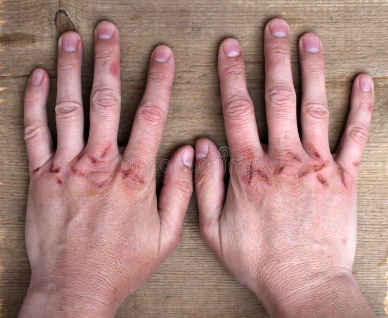 Damaged hands stock image. Image of ferocity, lesion - 90221789