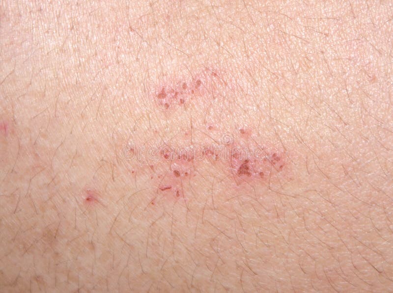 The damaged skin stock image. Image of detail, skin, rash - 37854517