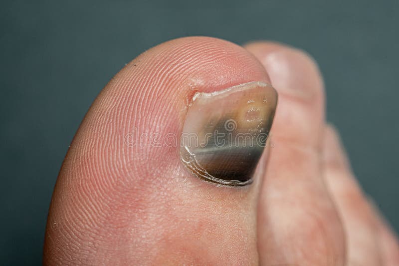 Damaged Toenail. Hematoma on the Thumb Stock Image - Image of bruised ...