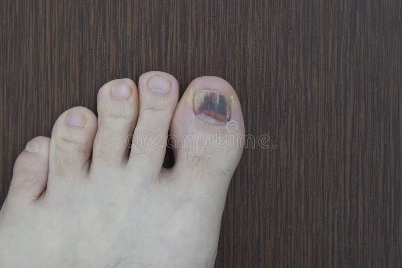 A Damaged Toenail on a Person`s Big Toe Stock Photo - Image of skin ...