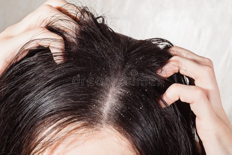 Female Hand Scratched Head Dandruff Stock Photos - Free & Royalty-Free ...