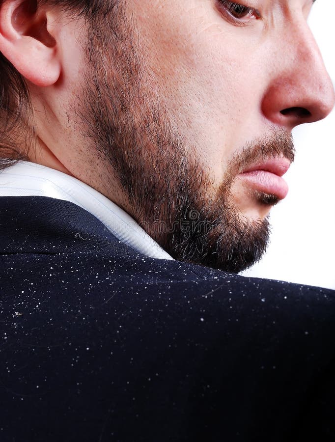 Dandruff Issue on Man S Sholder Stock Image - Image of human, malice ...