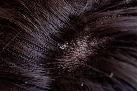 Dandruff problem stock image. Image of human, fungus - 20896433