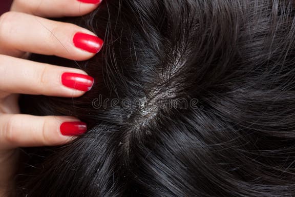 Dandruff problem stock photo. Image of scab, malice, hormonal - 20901824
