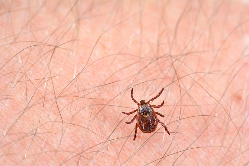Mite on the Skin. Danger of Tick Bite. Stock Image - Image of ...