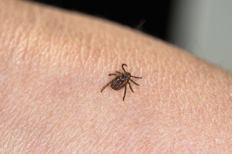A Dangerous Tick on Human Skin Stock Photo - Image of ixodid, epidemic ...