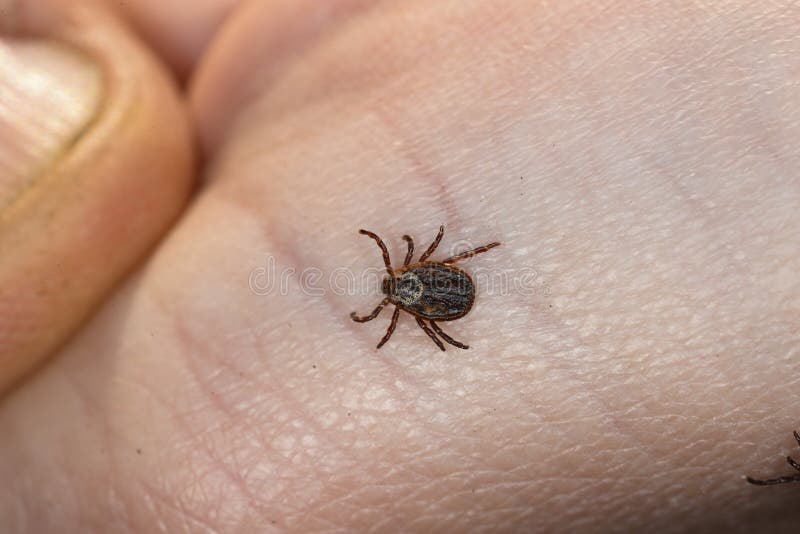 A Dangerous Tick on Human Skin Stock Photo - Image of ixodid, epidemic ...