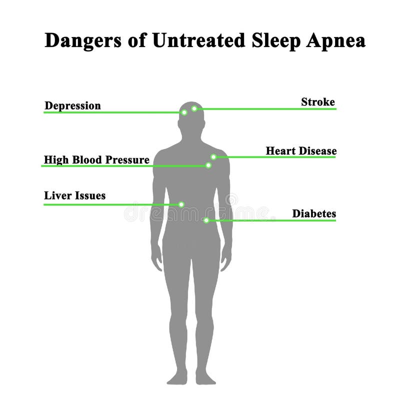 Sleep Apnea`s Associated Health Effects Stock Illustration ...