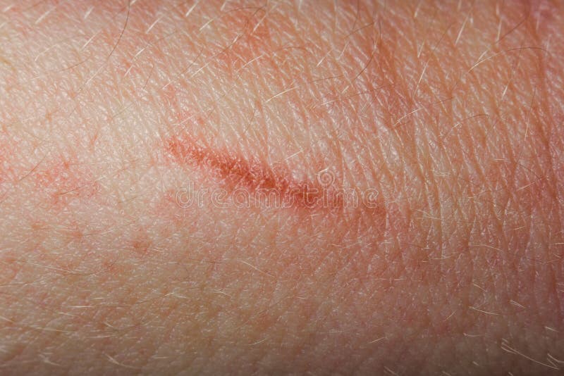 Struttura Di Pelle E Del Graffio Umani Fotografia Stock - Immagine di ...