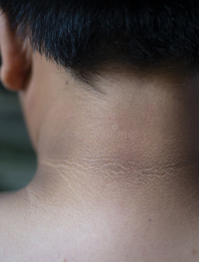 Dark Spots on the Skin of the Neck of a Person Stock Photo - Image of ...