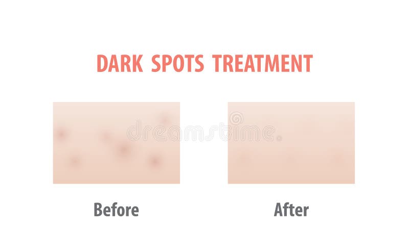 Comparison of Skin Barrier Vector Illustration on White Background ...