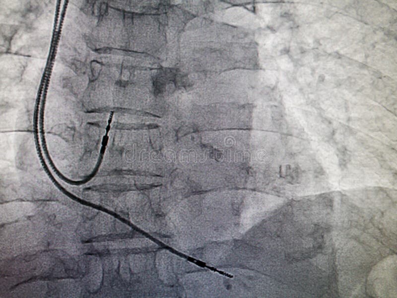 DDDR pacemaker cable stock photo. Image of examination - 74099880