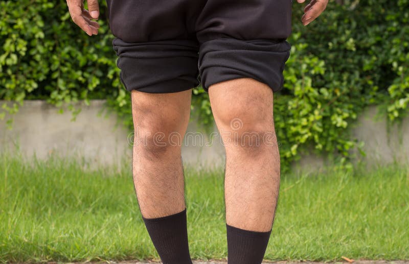 De Aziatische Vorm Met O-benen Van Het Mensenbeen Van De Benen Stock ...