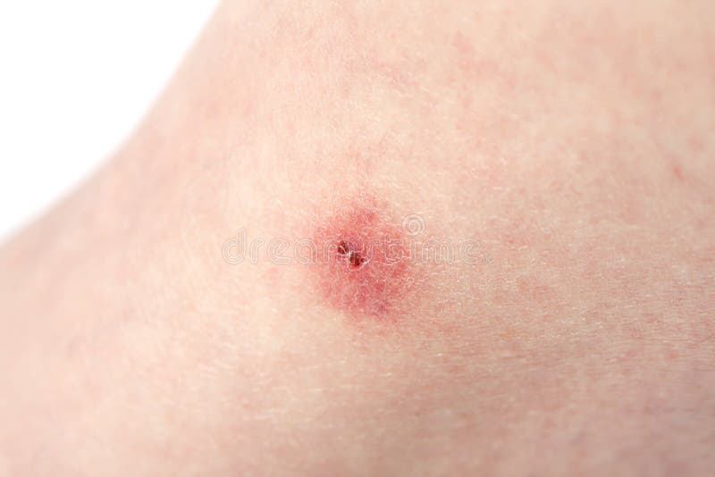 Insectenbeet stock afbeelding. Image of insect, droog - 17255485