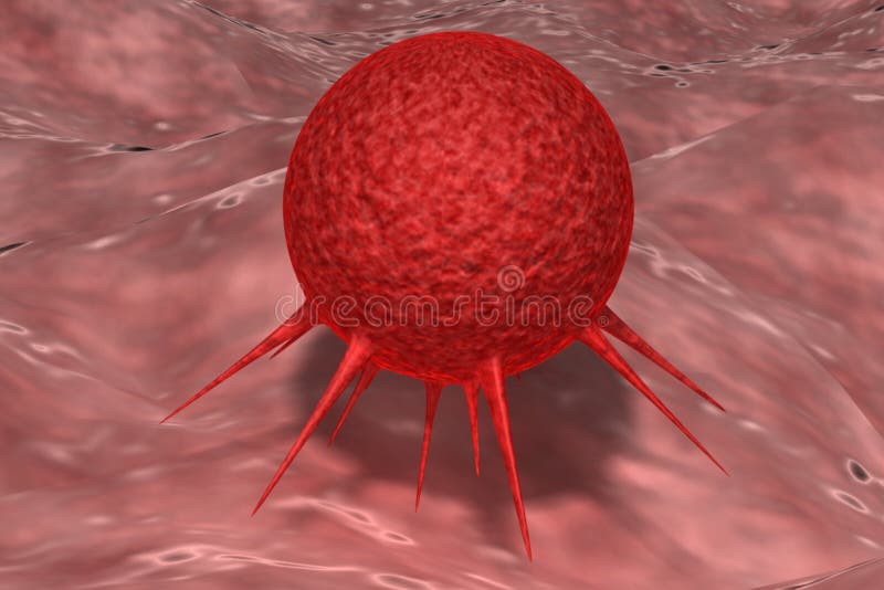 3d Medische Illustratie Van Huidkanker : Plaveiselcelcarcinoom ...