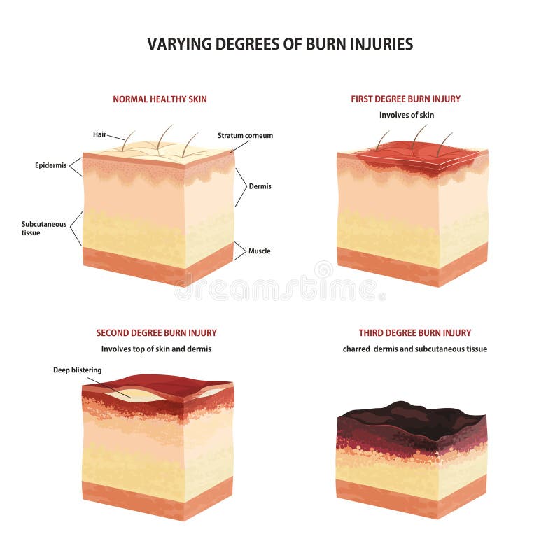 Huidbrandwond Drie Graden Brandwonden Type Van Verwonding Aan Huid ...