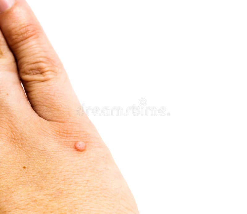 Verrue Sur Le Doigt De Main Photo stock - Image du bouton, formation ...
