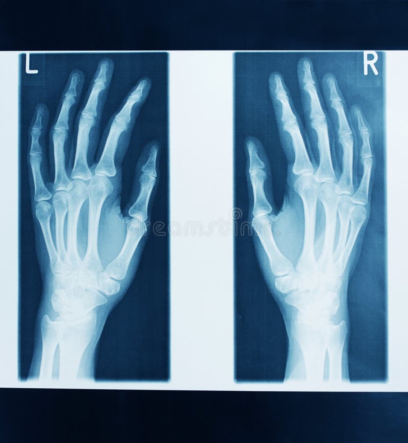 Röntgenfoto van de handen stock afbeelding. Image of voorwaarde - 20967115