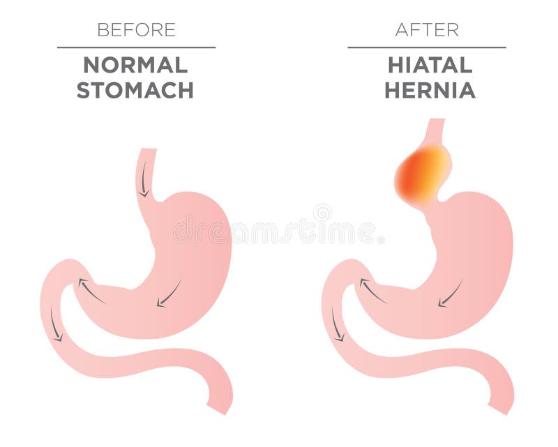 Types Van Ingewandsbreuk Epigastrisch, Zij, Umbilical, Inguinal, Dij ...