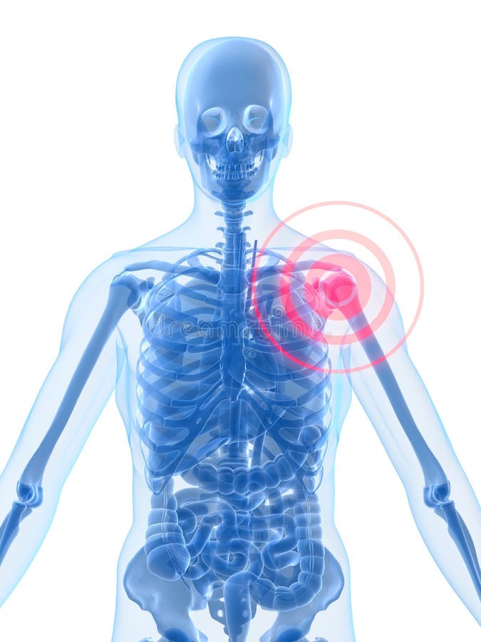 De Ontsteking Van De Schouder Stock Illustratie - Illustration of ...