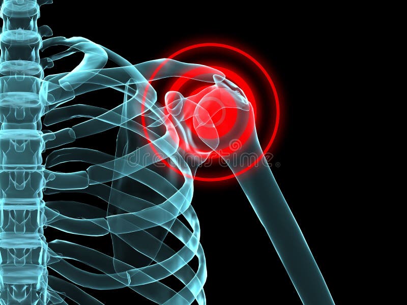 De Ontsteking Van De Schouder Stock Illustratie - Illustration of ...