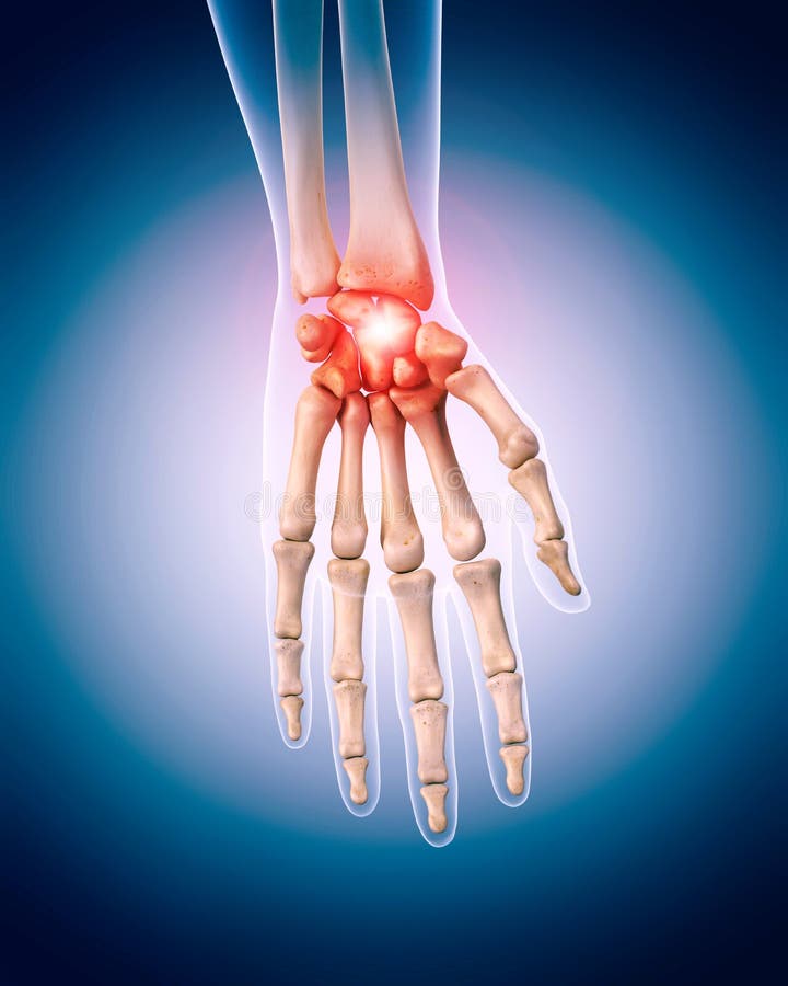 Pijnlijke Pijn in De Handpalm of Pols Stock Illustratie - Illustration ...