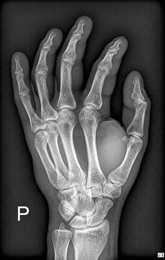 Gebroken Hand Medische Röntgenstraal Stock Afbeelding - Image of ...