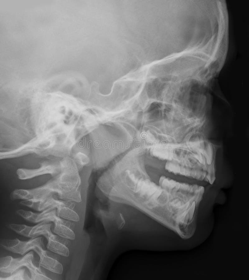 De Röntgenstraal Van De Schedel Stock Foto - Image of radiologie, zorg ...