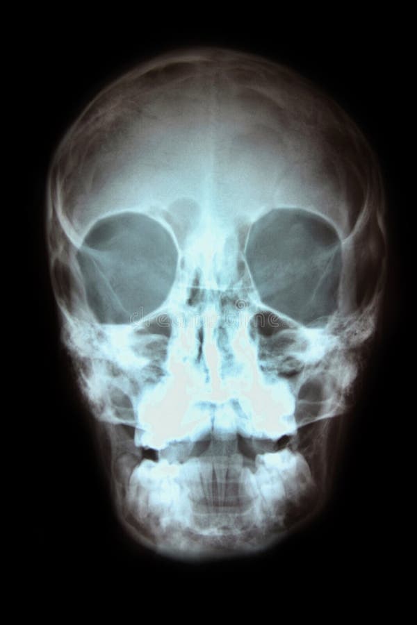 Film X-ray Schedel Van Menselijk En Leeg Gebied Bij Medische ...