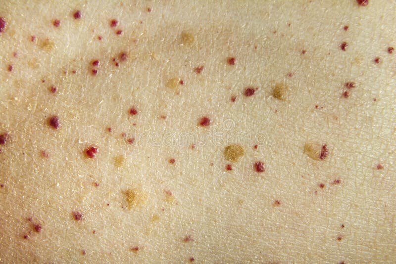 De Rode Freckled Witte Macro Van De Huid Stock Afbeelding - Image of ...