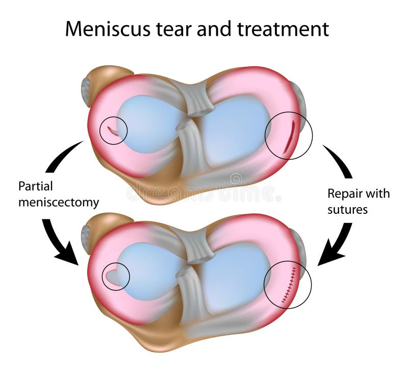 De Scheur En De Chirurgiebehandeling Van De Meniscus Vector Illustratie ...