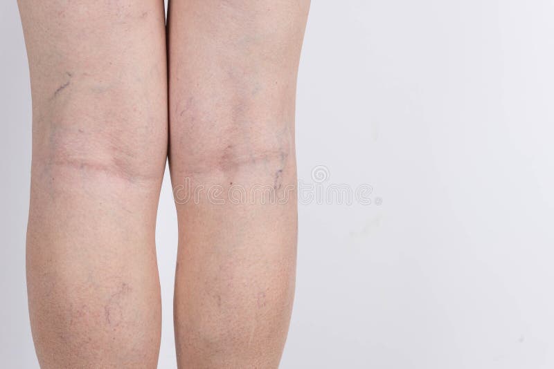 De Spataders Op Benen Van Vrouw Stock Foto - Image of voet, compressie ...