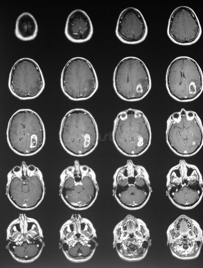 Mri Van Hersenen Die Hersenentumor Toont Stock Afbeelding - Image of ...