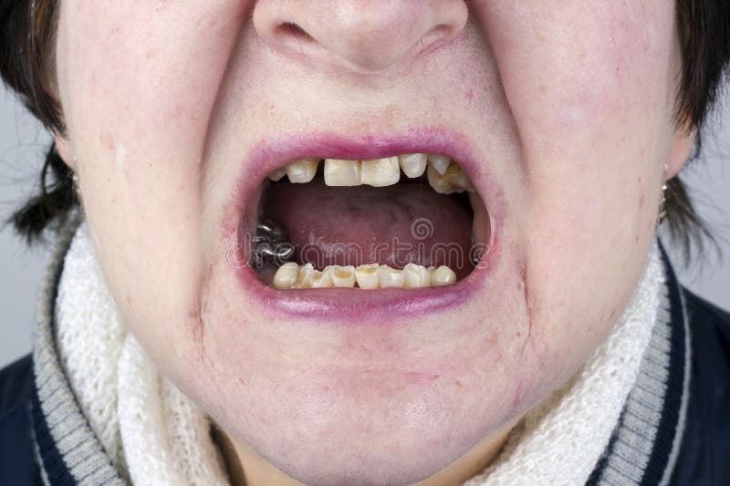 De Tanden Van Een Bejaarde Worden Bedorven Door Bederf, Tandsteen En Po ... De Tanden Van Een Bejaarde Worden Bedorven Door Bederf, Tandsteen En Po ...