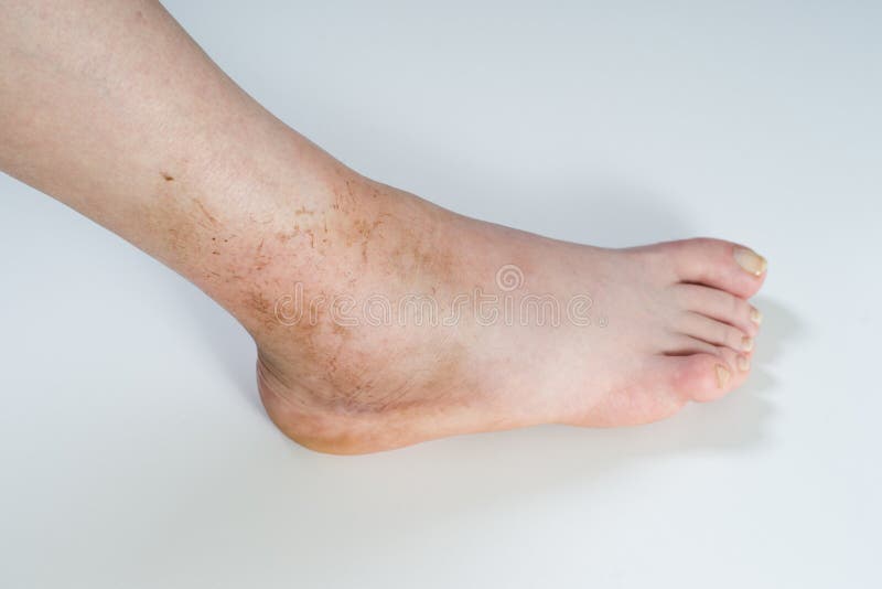 De Verstuiking Van De Enkel Stock Foto - Image of voet, enkel: 18636234