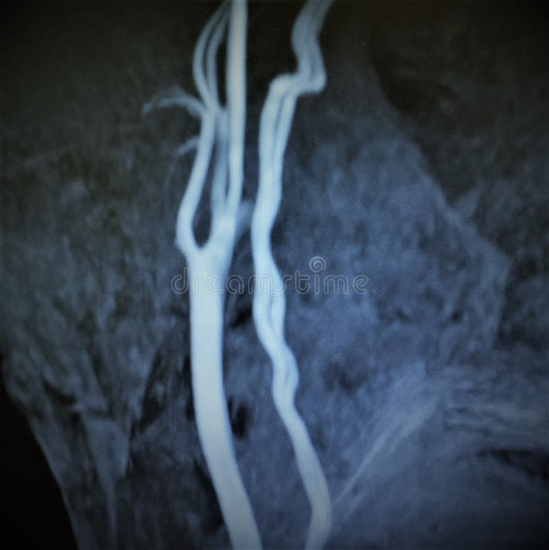 De Volledige Occlusie Van De Halsslagader Van De Mrislagader Stock ...