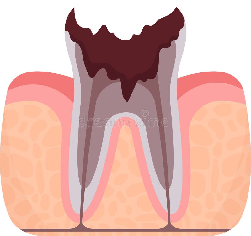Dead Tooth Problem stock vector. Illustration of abscess - 285678194
