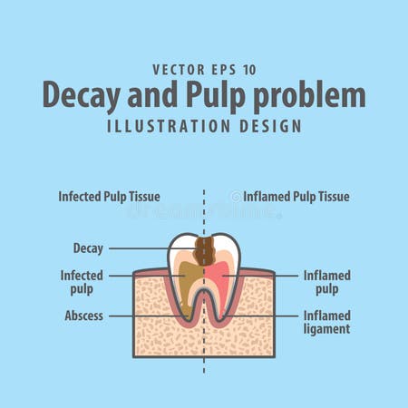 Tooth Decay Diagram Stock Illustrations – 541 Tooth Decay Diagram Stock ...