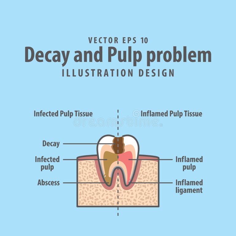 Tooth Decay Diagram Stock Illustrations – 541 Tooth Decay Diagram Stock ...