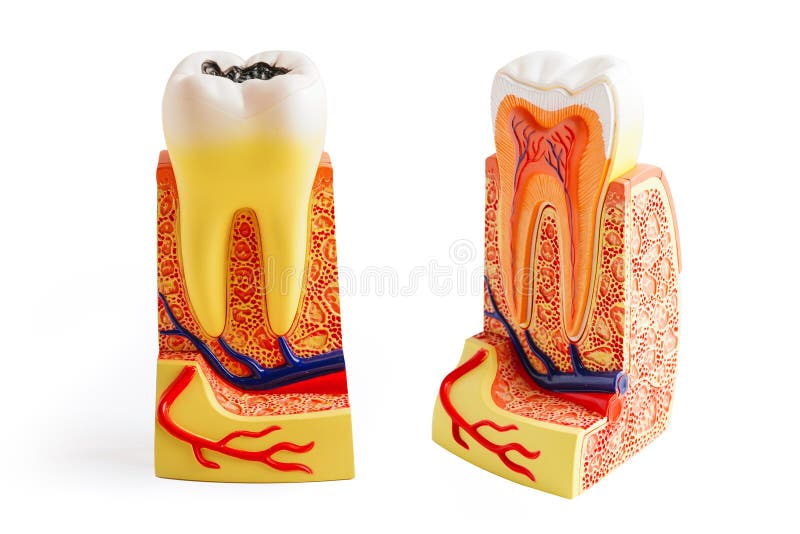 Decay Tooth Replace with Dental Implant Root Canal Teeth Model for ...