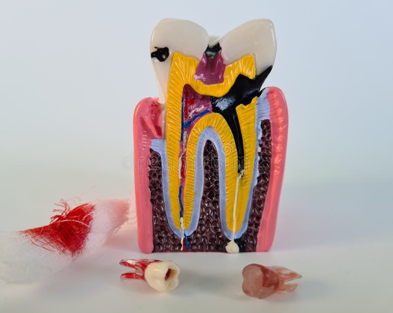 Decayed Root Tooth is Removed. Caries and Tooth Extraction and Dental ...